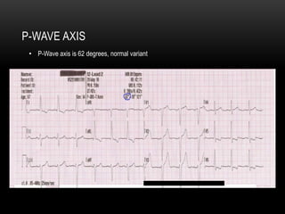 P wave axis and escape rhythms | PPTX