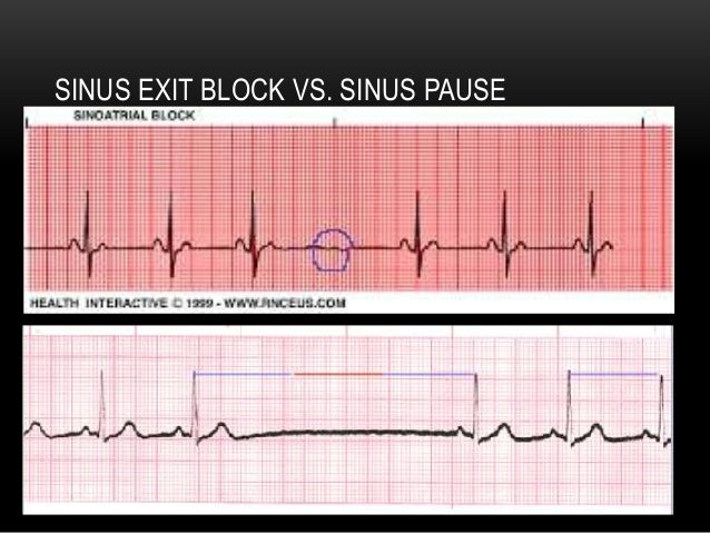 P wave axis and escape rhythms