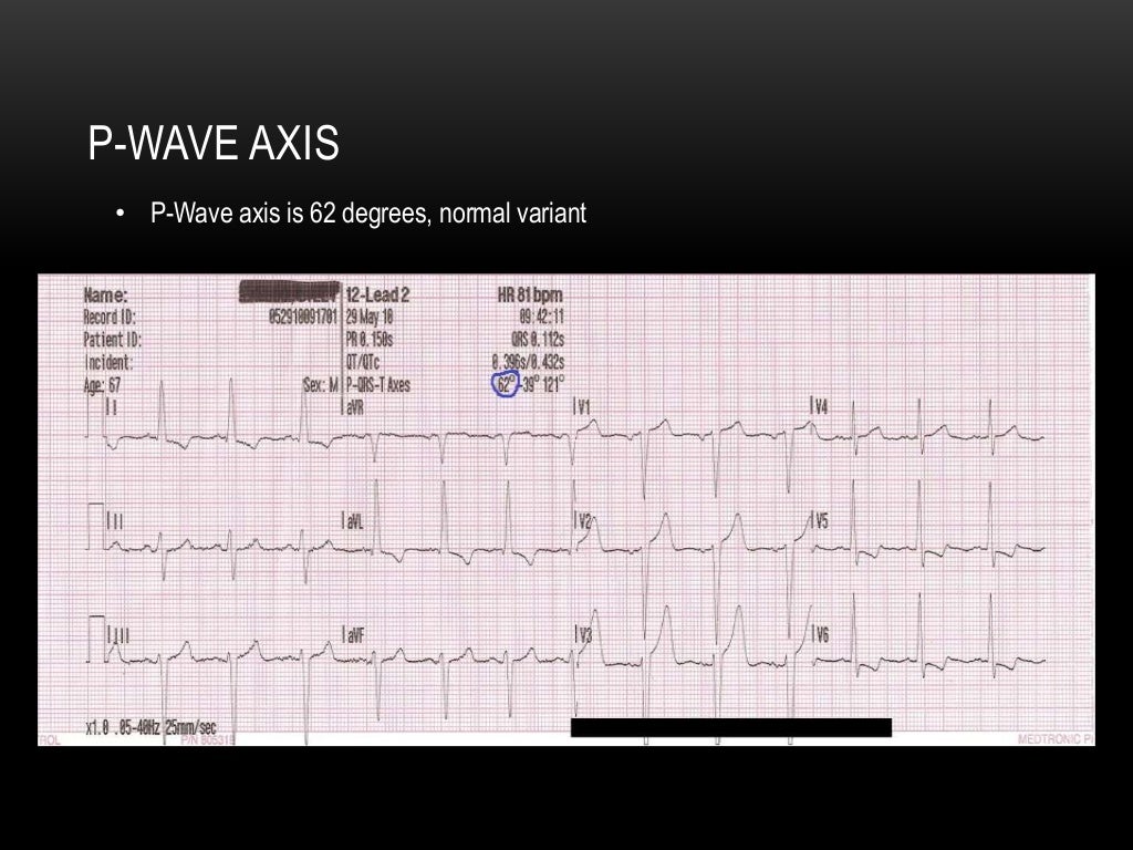 P wave axis and escape rhythms