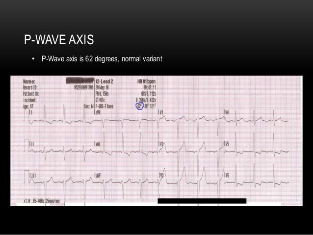 P wave axis and escape rhythms