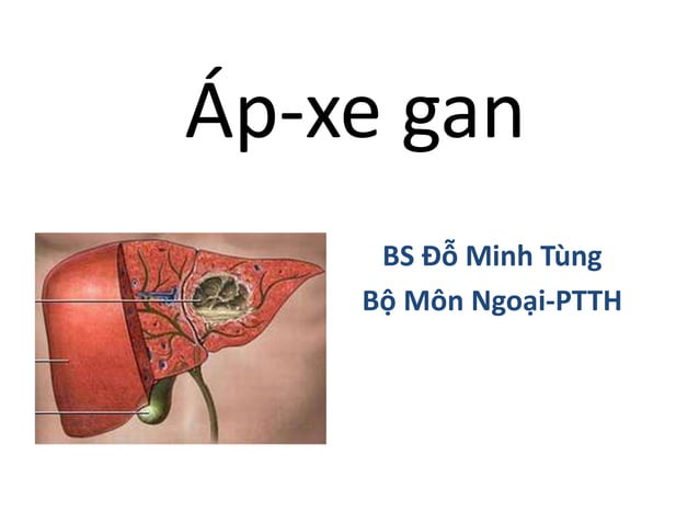 Áp-xe gan.ppt