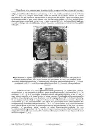 Macrodontia of an impacted upper second premolar: acase report of a ...