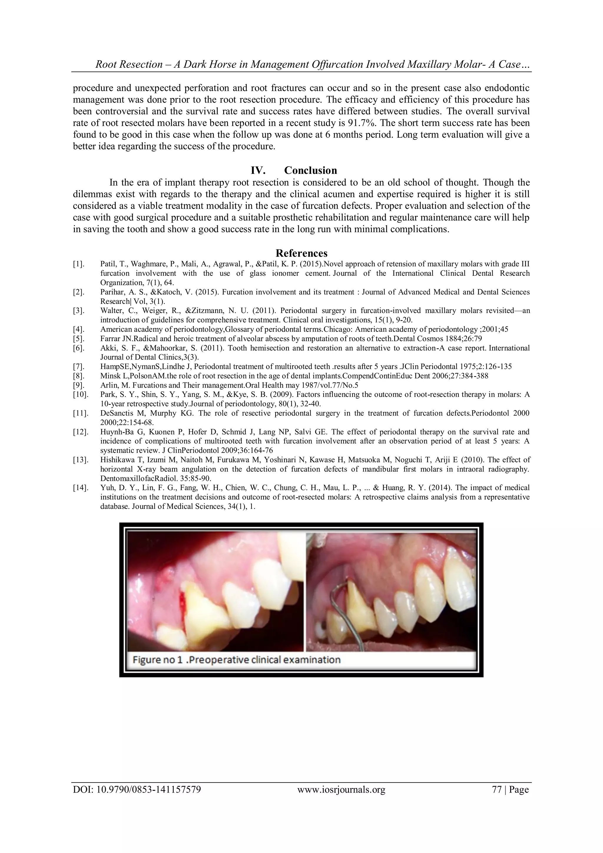 Root Resection – A Dark Horse in Management Offurcation Involved ...