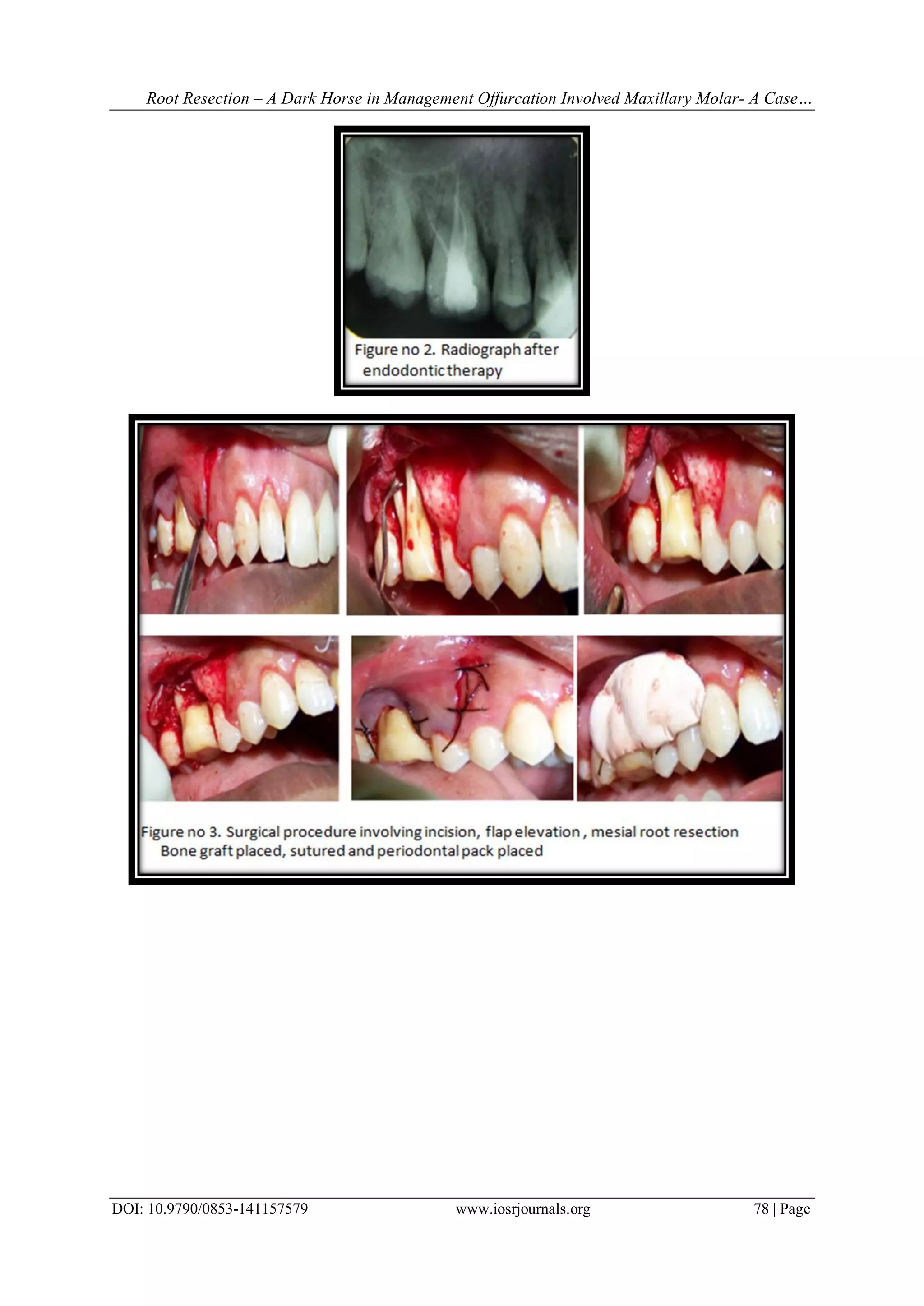 Root Resection – A Dark Horse in Management Offurcation Involved ...