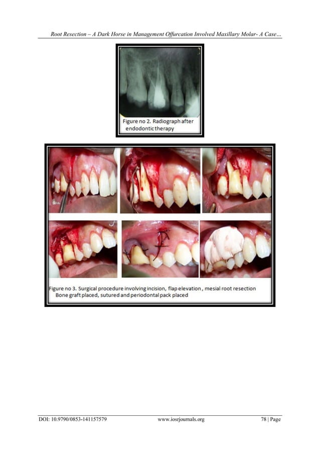 Root Resection – A Dark Horse in Management Offurcation Involved ...