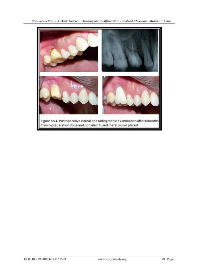 Root Resection – A Dark Horse in Management Offurcation Involved ...