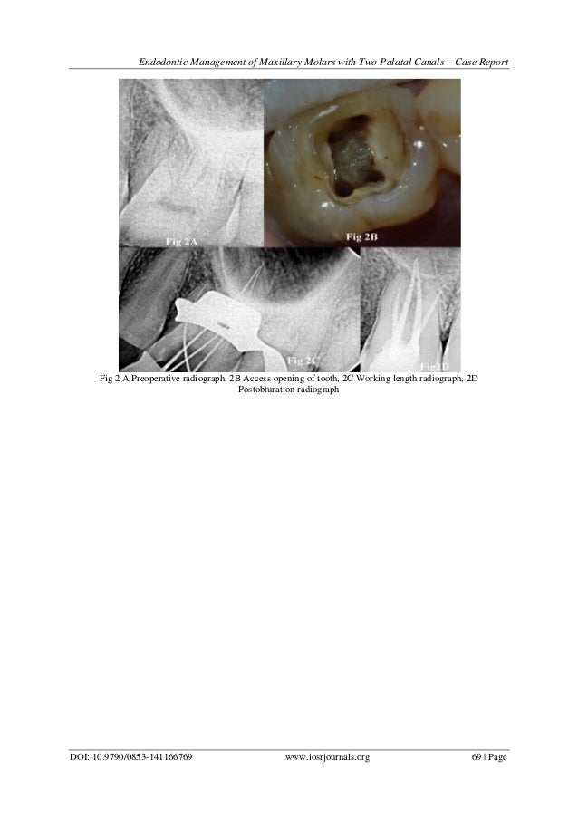 Endodontic Management of Maxillary Molars with Two Palatal Canals – C…
