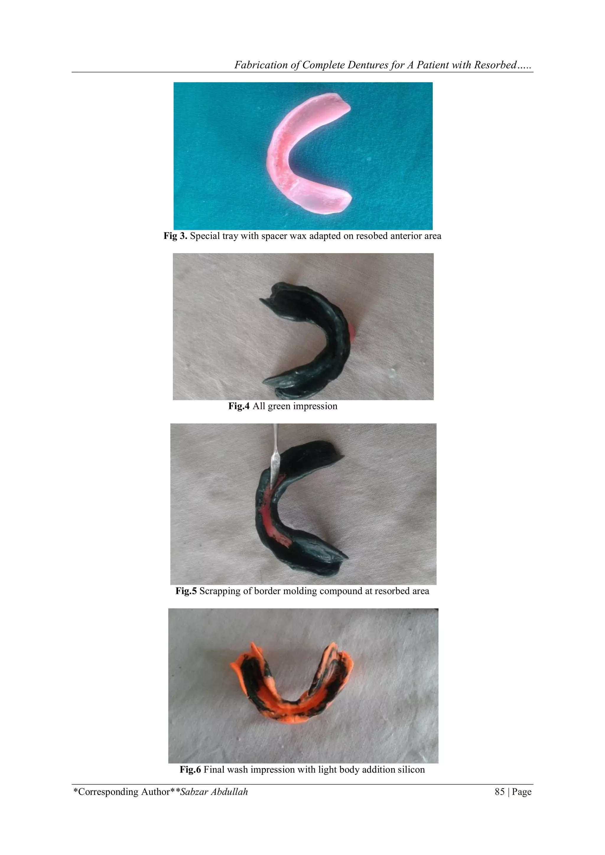 Fabrication of Complete Dentures for A Patient with Resorbed Mandibular ...