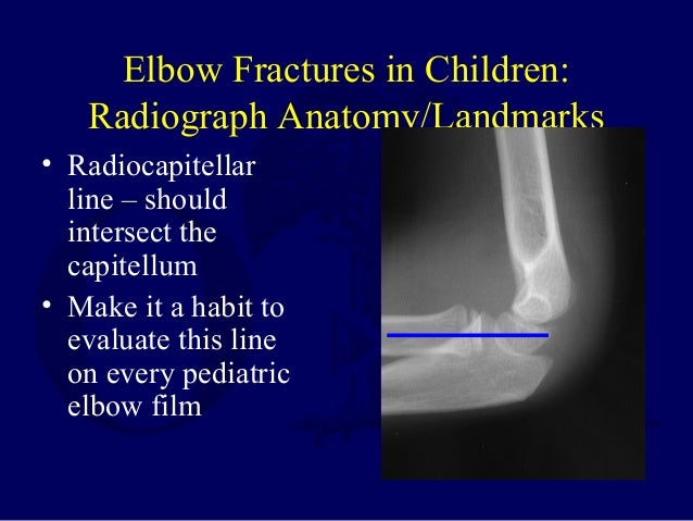 P05 pediatric elbow