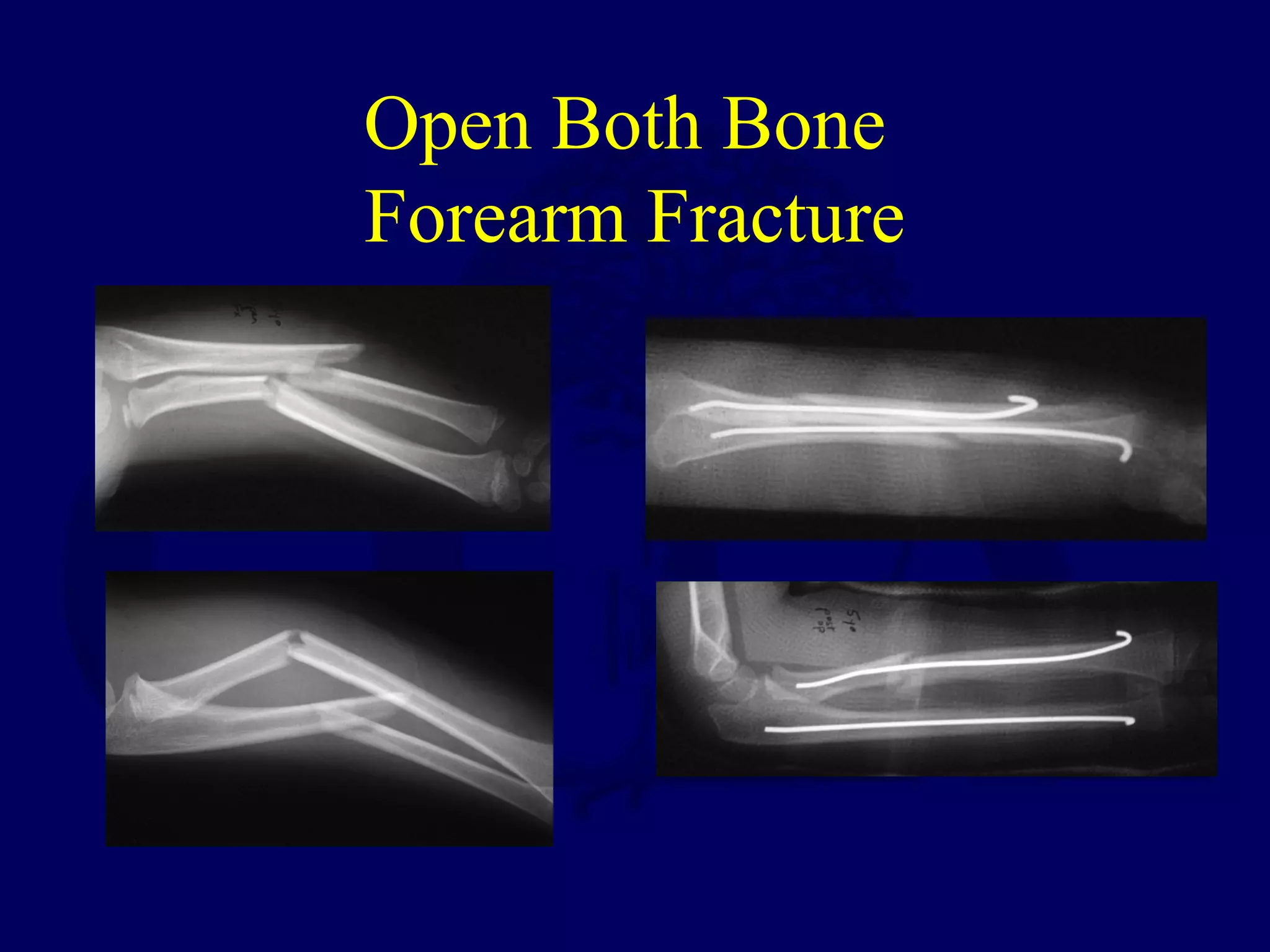 P06 pediatric forearm, hand | PPT
