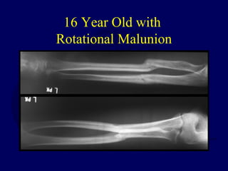 P06 pediatric forearm, hand | PPT
