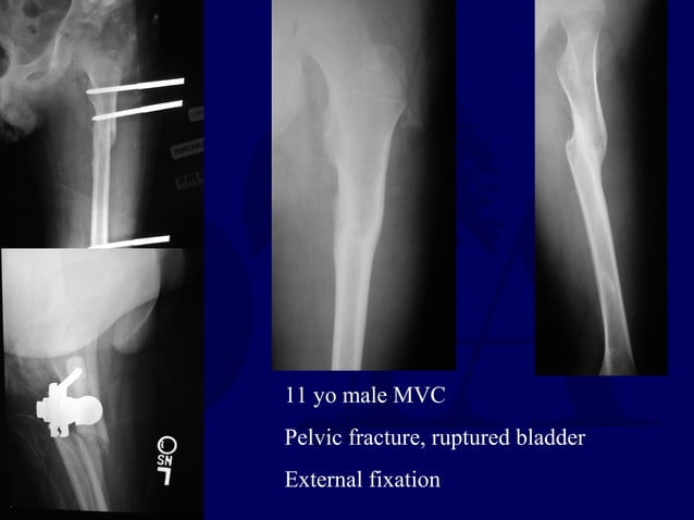 P09 pediatric femur | PPT