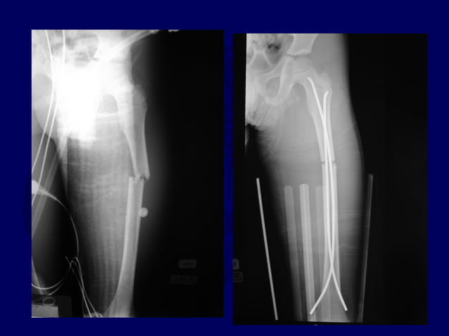 P09 pediatric femur | PPT