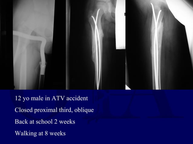 P09 pediatric femur | PPT