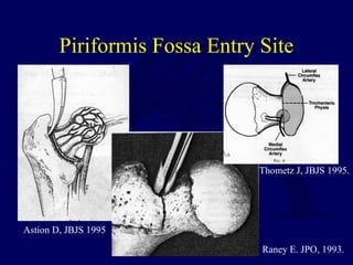 Piriform Fossa Femur
