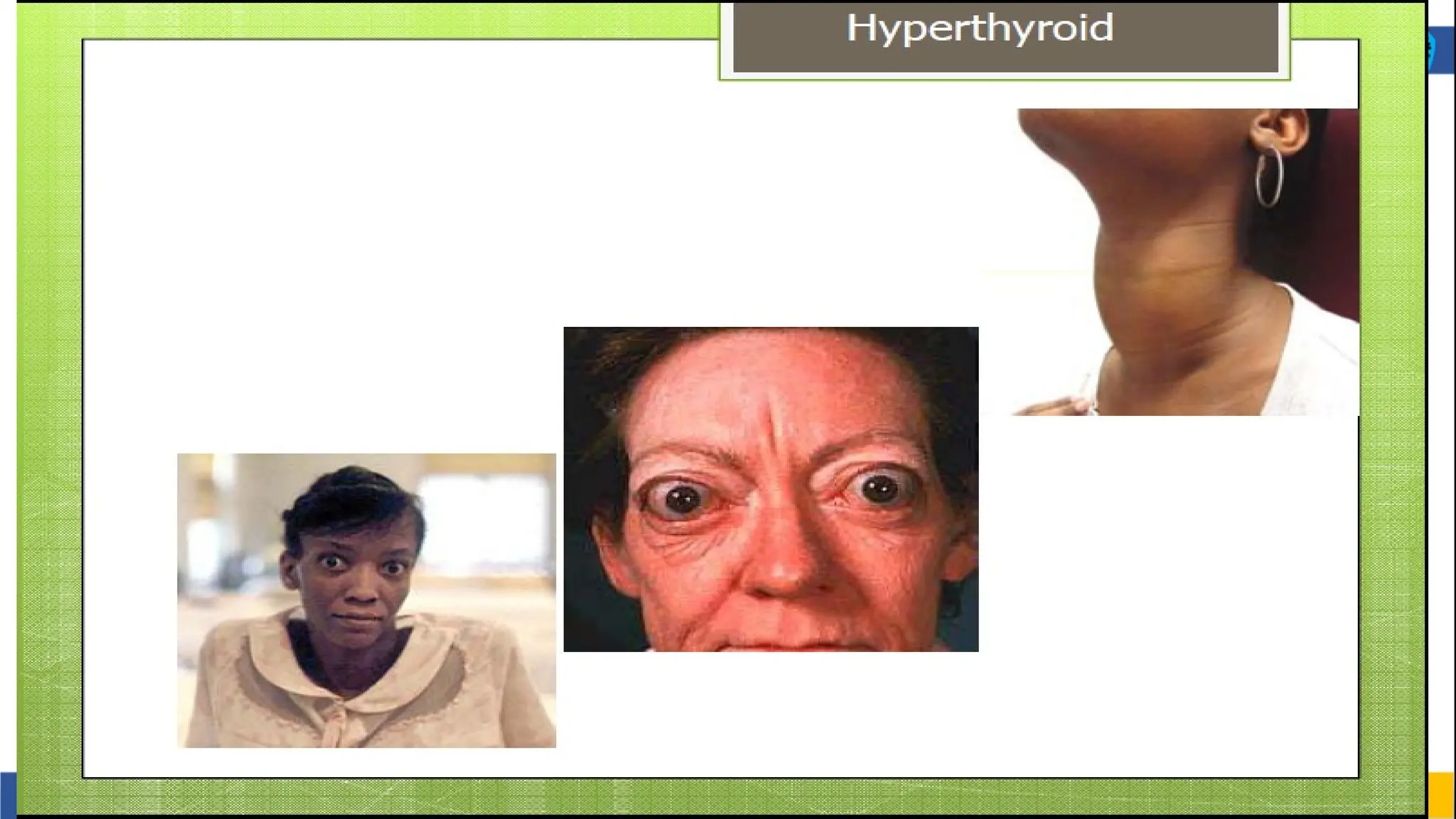 Tatalaksana Terapi pada Pasien dengan Gangguan TIROID | PPTX