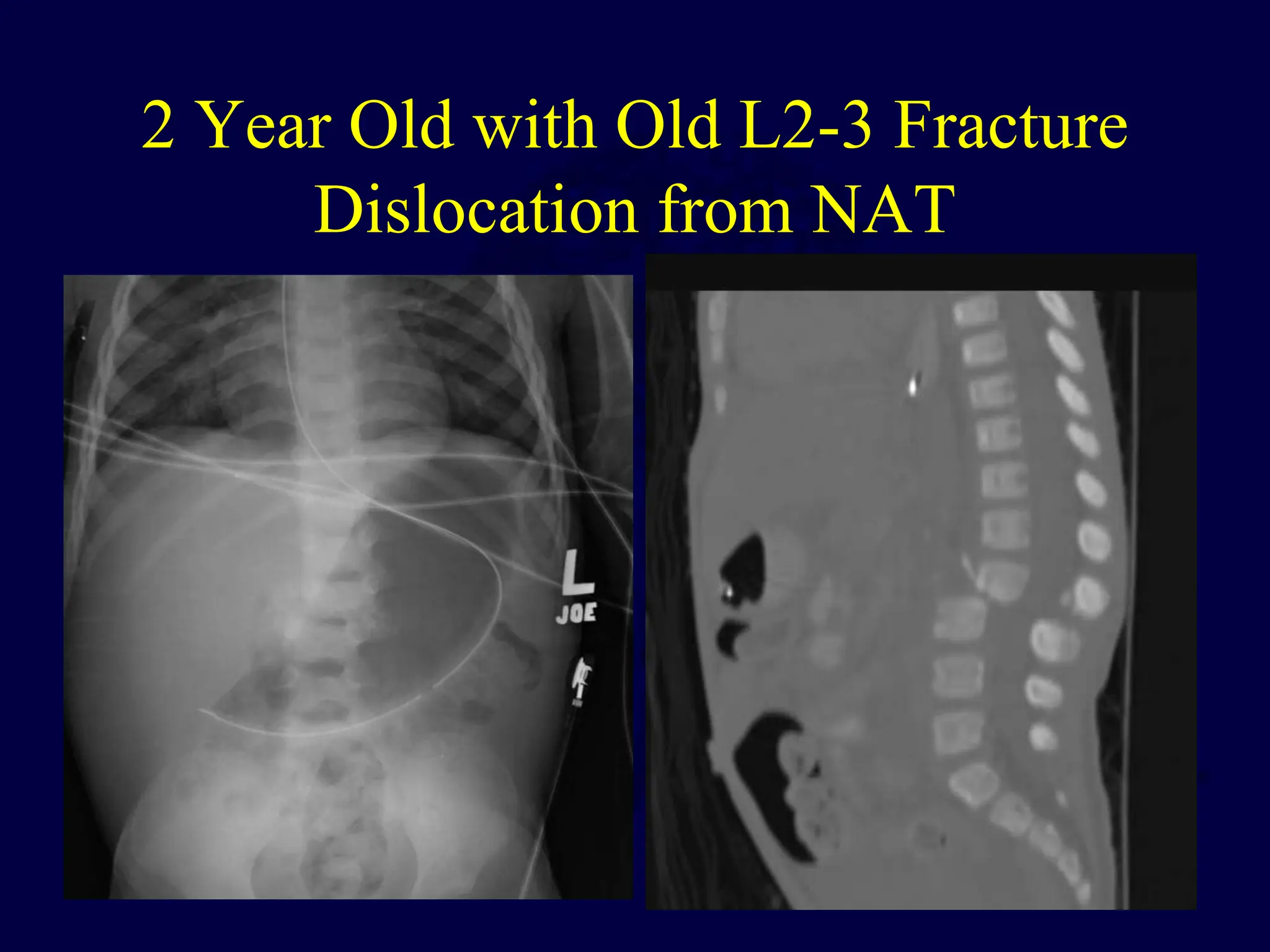 the Pediatric Spine fractures lecture.ppt
