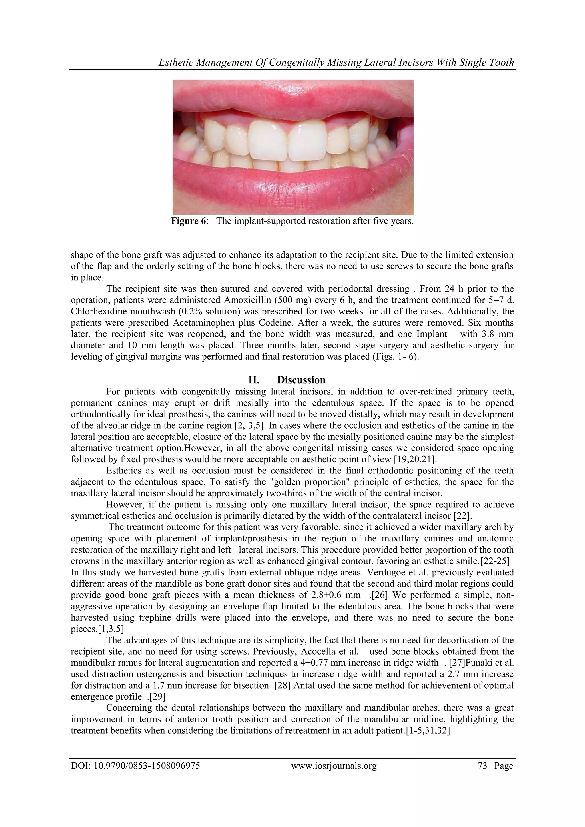 Esthetic Management of Congenitally Missing Lateral Incisors With ...