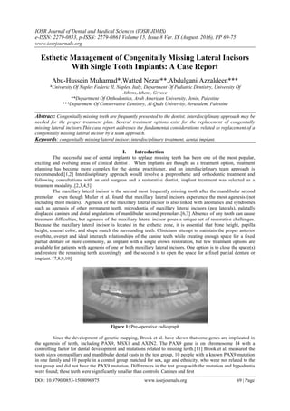 Esthetic Management of Congenitally Missing Lateral Incisors With ...