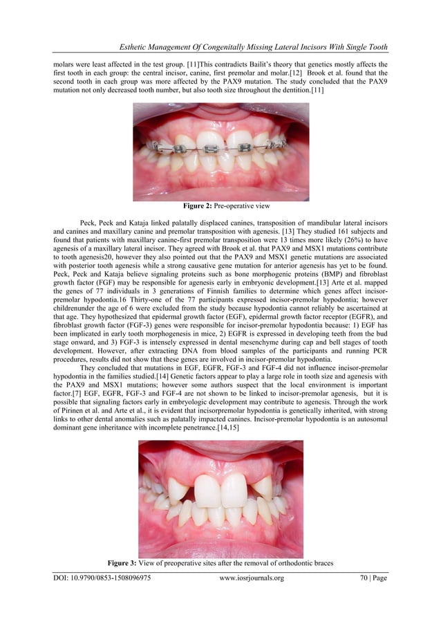 Esthetic Management of Congenitally Missing Lateral Incisors With ...