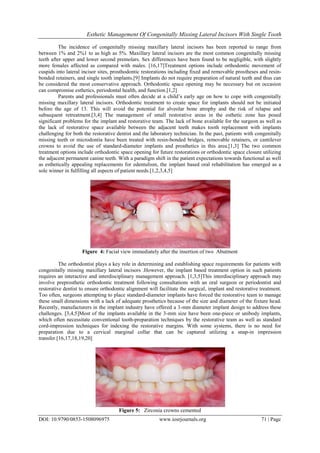 Esthetic Management of Congenitally Missing Lateral Incisors With ...