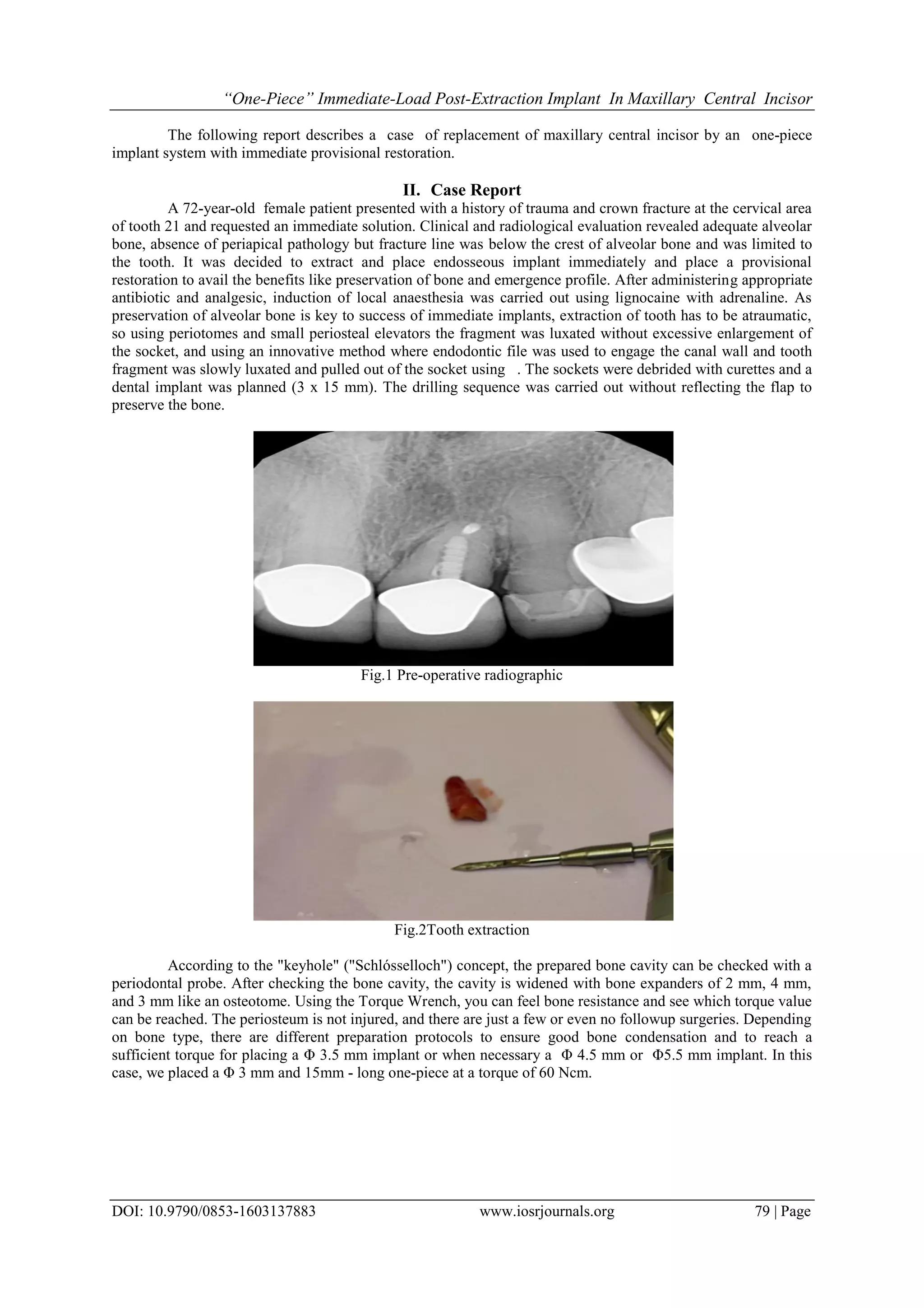 “One-Piece” Immediate-Load Post-Extraction Implant In Maxillary Central ...