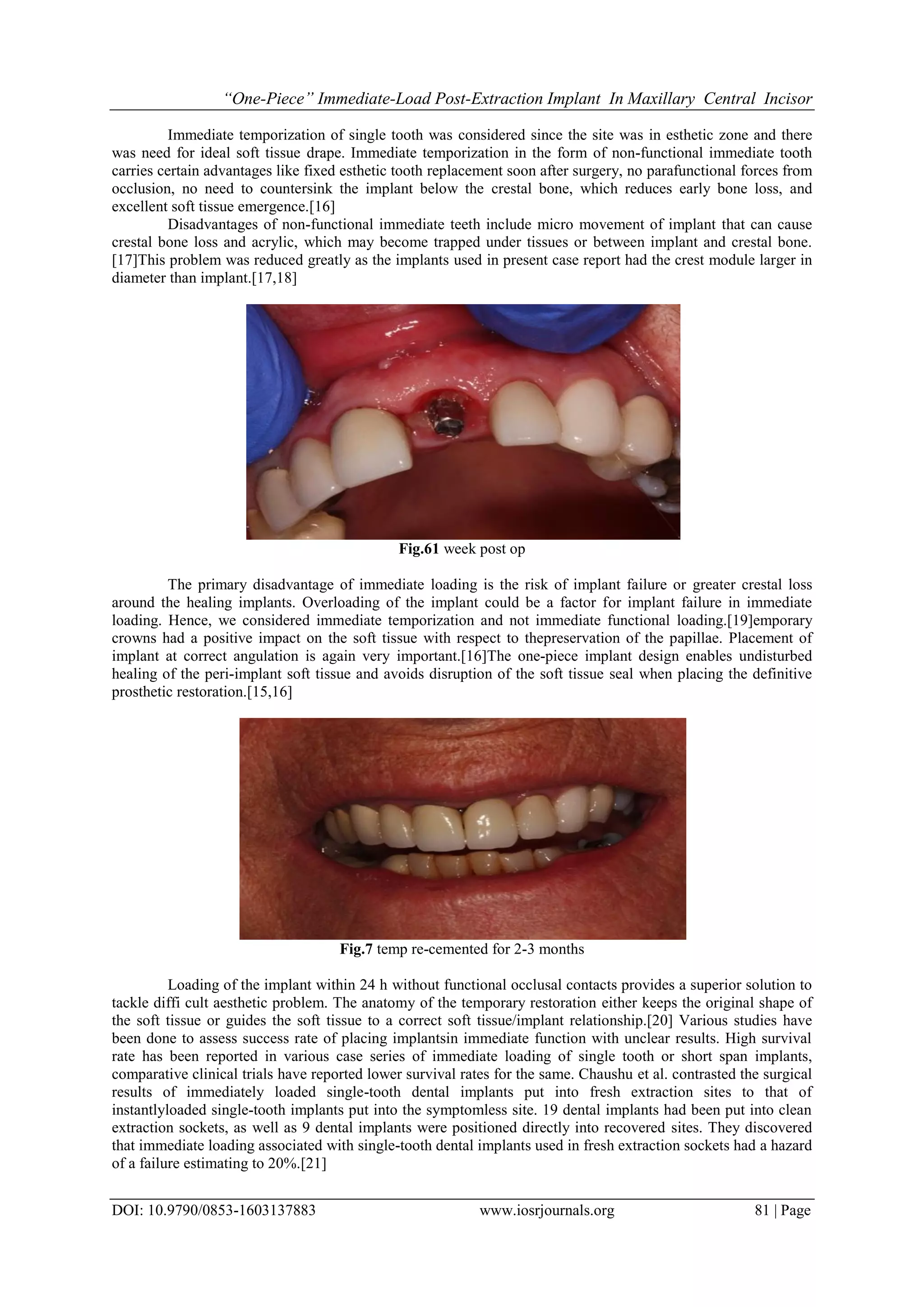 “One-Piece” Immediate-Load Post-Extraction Implant In Maxillary Central ...