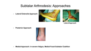 Subtalar Arthritis Management Options | PPT