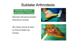 Subtalar Arthritis Management Options | PPT