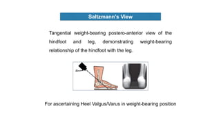 Subtalar Arthritis Management Options | PPT