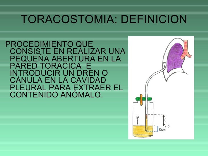 Toracostomia 1