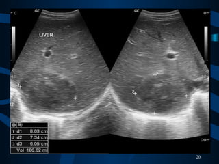 P 3a abses hati amuba | PPT