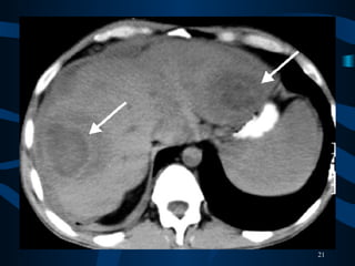 P 3a abses hati amuba | PPT