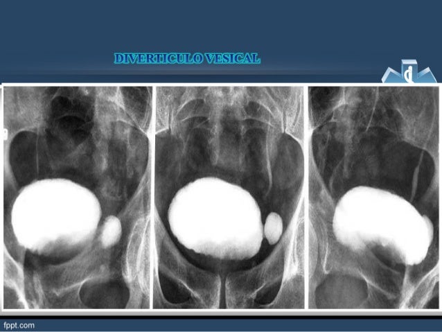 CISTOGRAFÍA Y URETROCISTOGRAFÍA