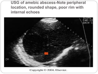 Liver abscess 1 | PPTX
