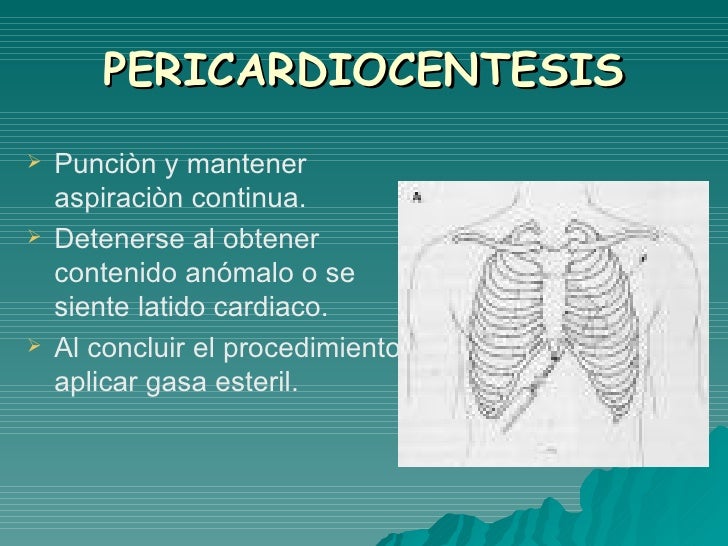 Pericardiocentesis