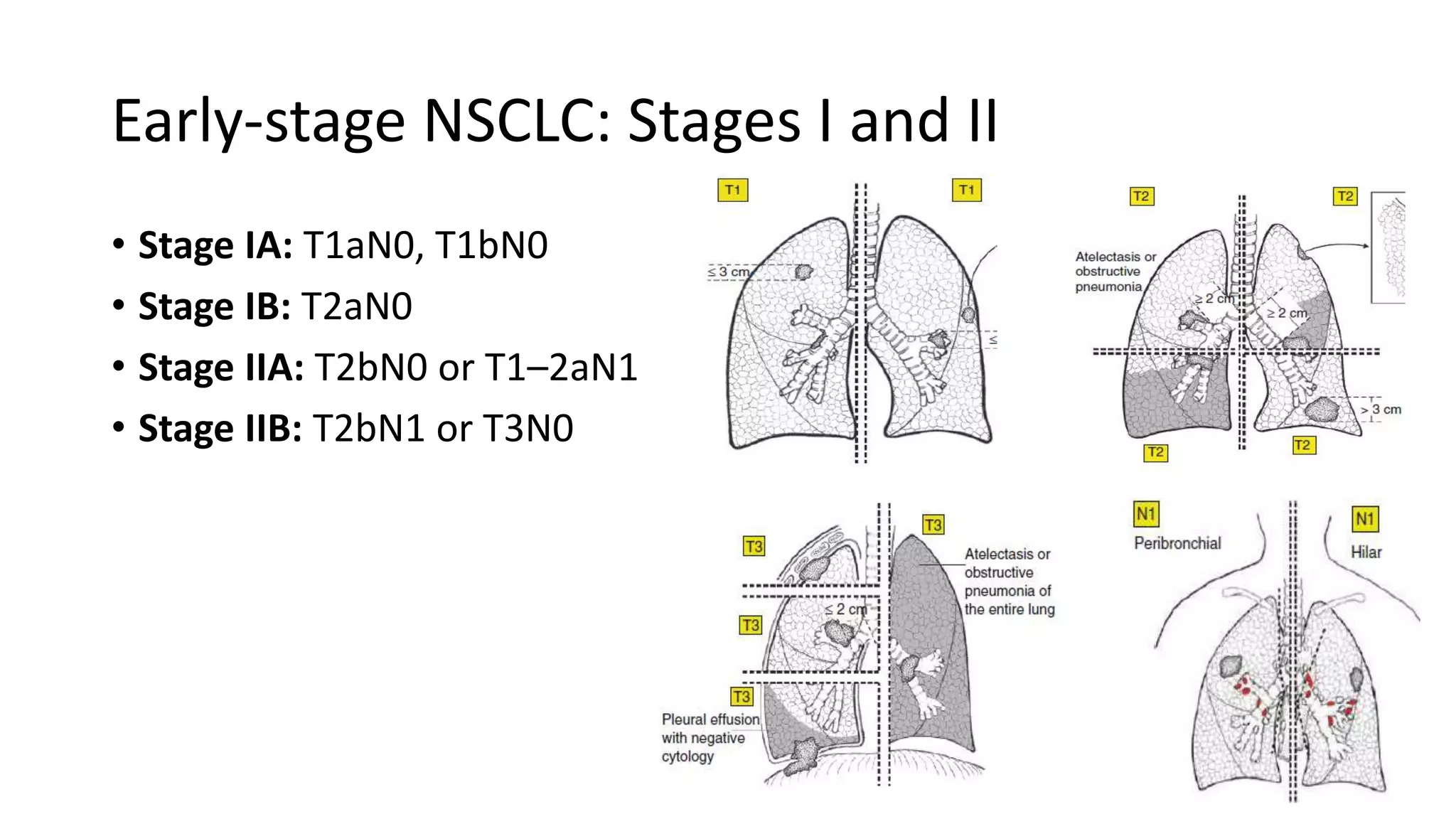 MANAGEMENT OF EARLY STAGE NON SMALL CELL LUNG CARCINOMA | PPTX