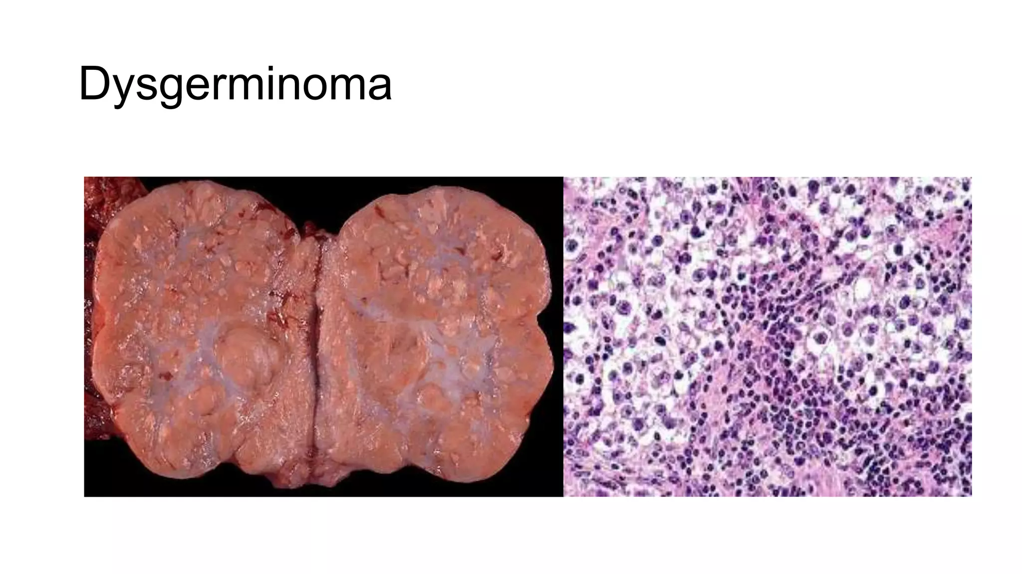 P 9 male and female genital tract disorders | PPTX