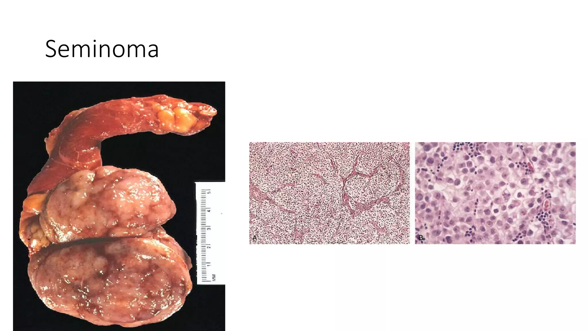 P 9 male and female genital tract disorders | PPTX