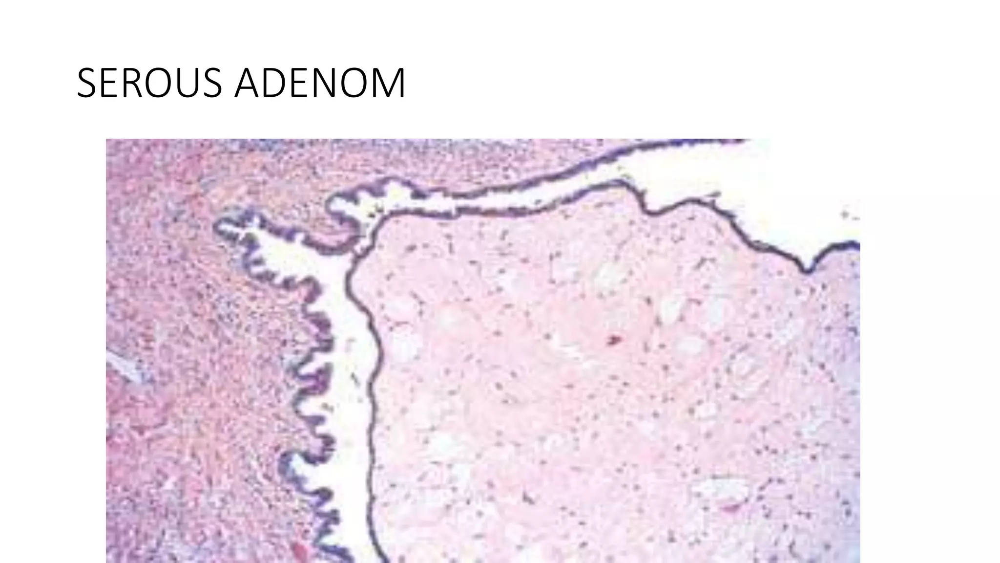 P 9 male and female genital tract disorders | PPTX