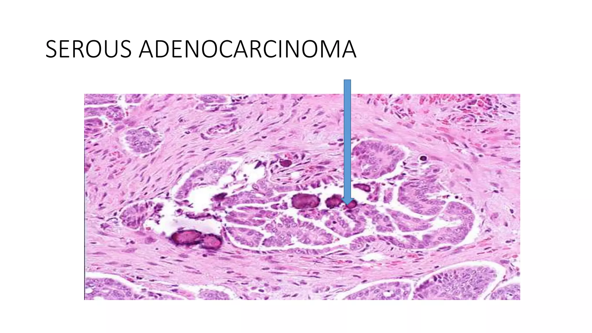 P 9 male and female genital tract disorders | PPTX