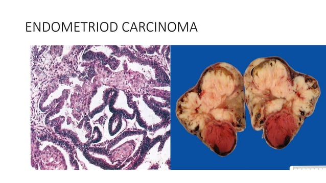 P 9 male and female genital tract disorders | PPT