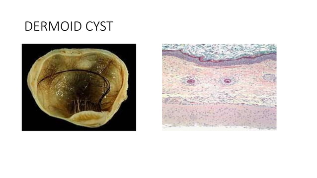 P 9 male and female genital tract disorders | PPT