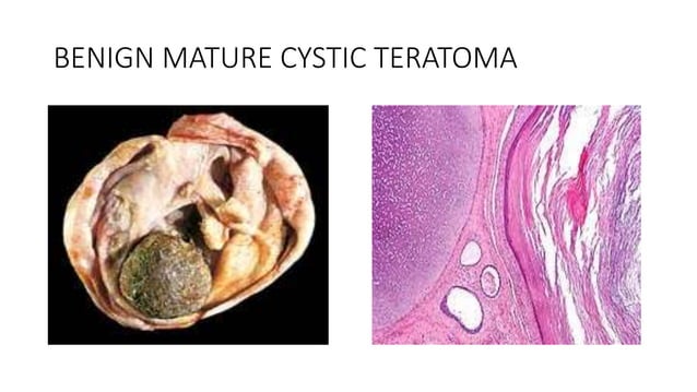 P 9 male and female genital tract disorders | PPT