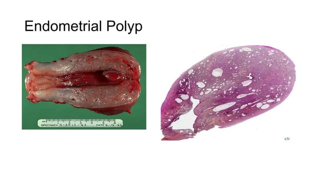 P 9 male and female genital tract disorders | PPT