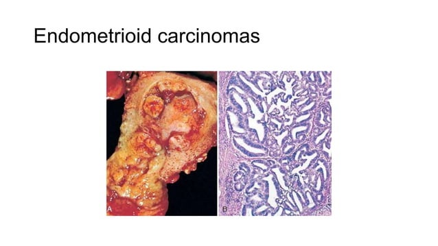 P 9 male and female genital tract disorders | PPT