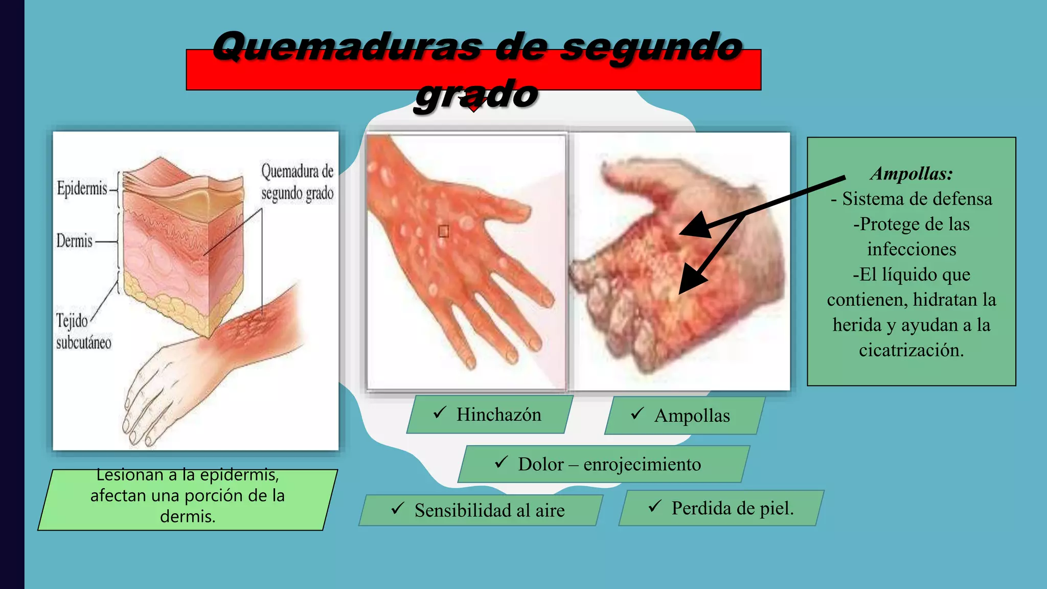 Primeros Auxilios en quemaduras | PPTX