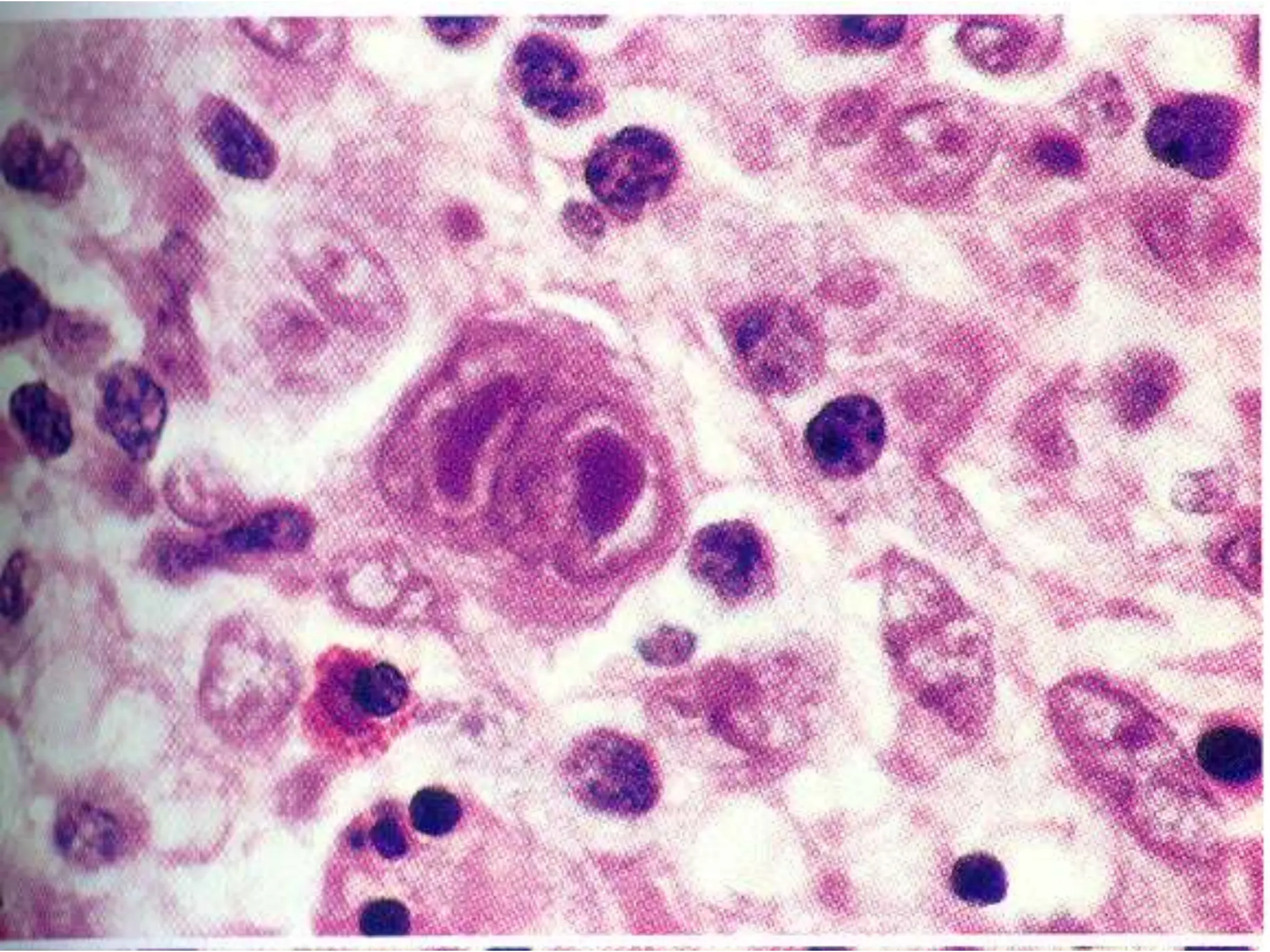 HODGKIN LYMPHOMA - DEFINITION, PATHOGENESIS & PATHOLOGY | PPT