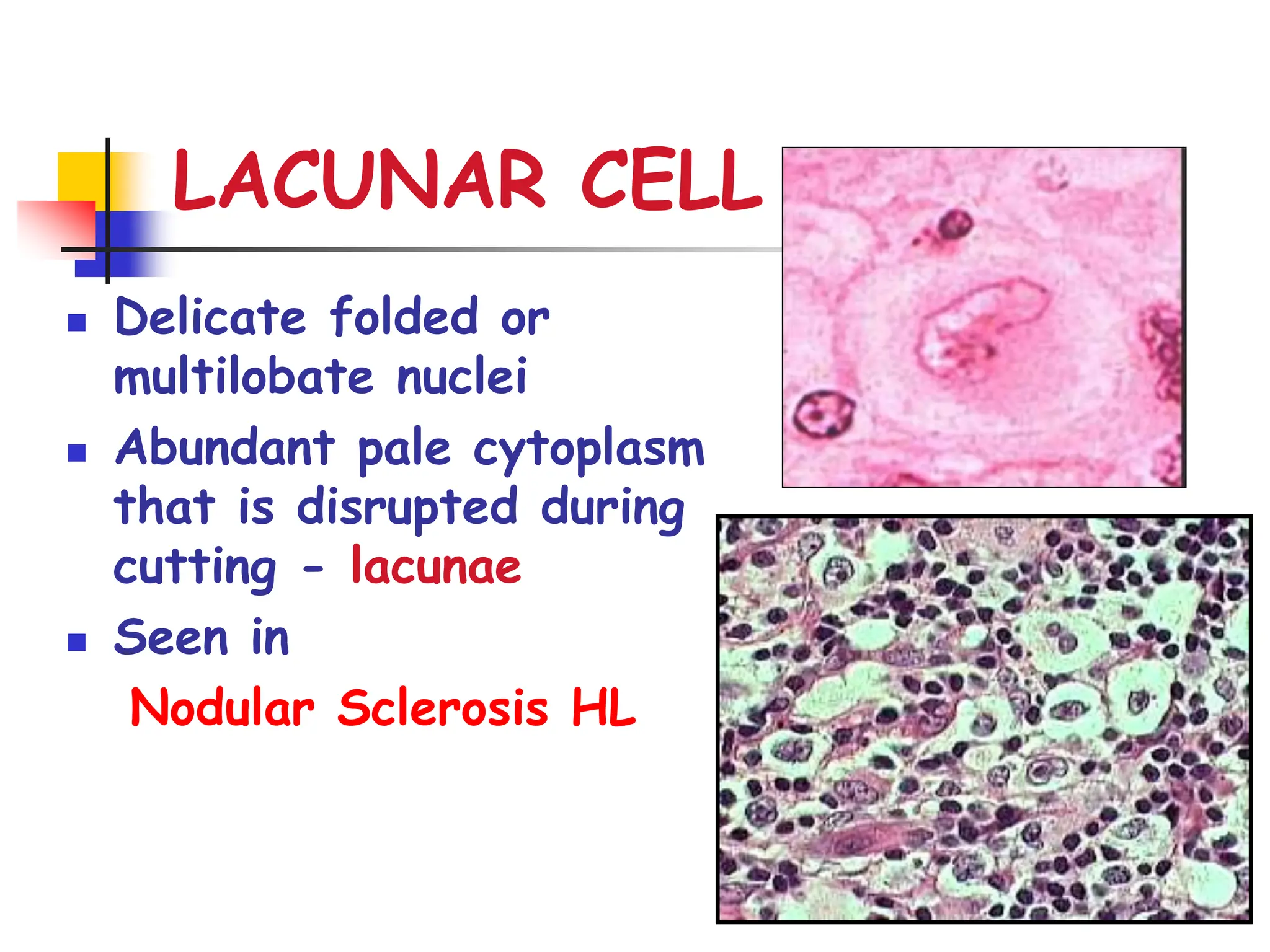 HODGKIN LYMPHOMA - DEFINITION, PATHOGENESIS & PATHOLOGY | PPT