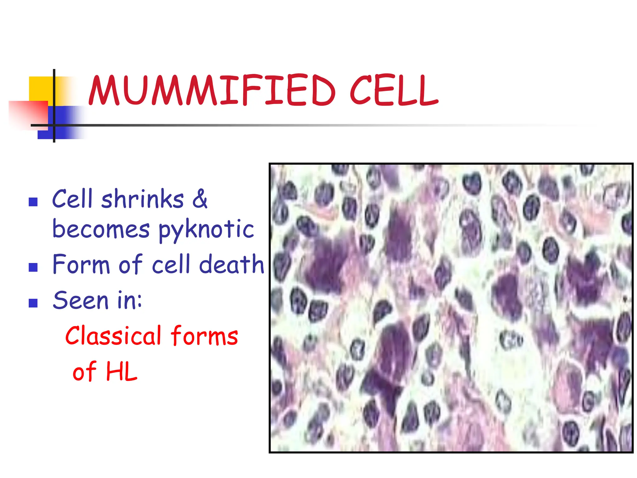 HODGKIN LYMPHOMA - DEFINITION, PATHOGENESIS & PATHOLOGY | PPT